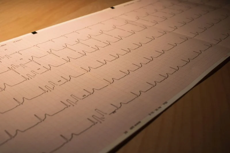 What to Know About Your EKG Results: A Complete Patient Guide
